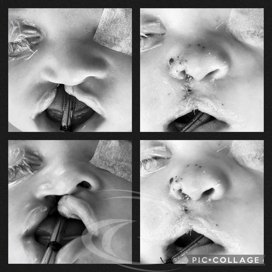 Cirurgia de lábio leporino: antes e depois - Dra. Clarice Abreu ...